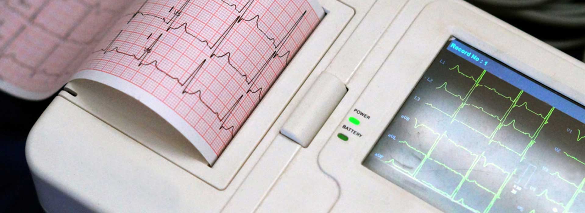 Sinus Node Dysfunction Causes Symptoms And More