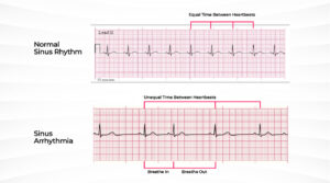 What is Sinus Arrhythmia? Symptoms, Causes & Treatment