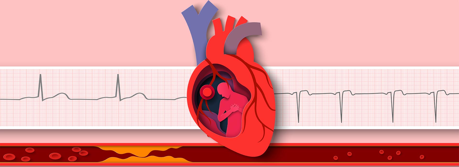 Left Atrial Enlargement: Symptoms, Causes, & Treatment