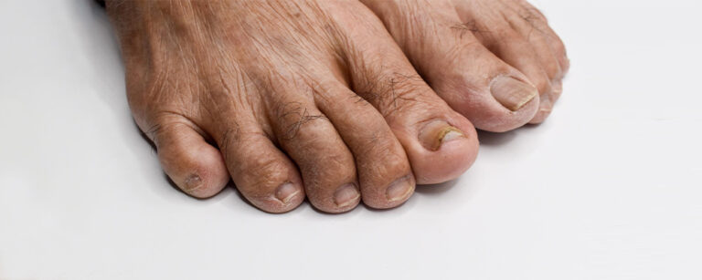 Black Toenail Diabetes: Can It Indicate a Health Concern?